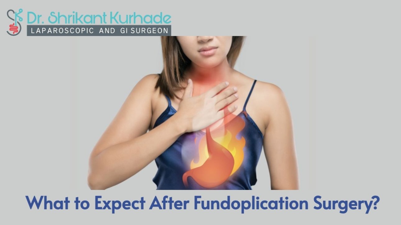 What to Expect After Fundoplication Surgery?