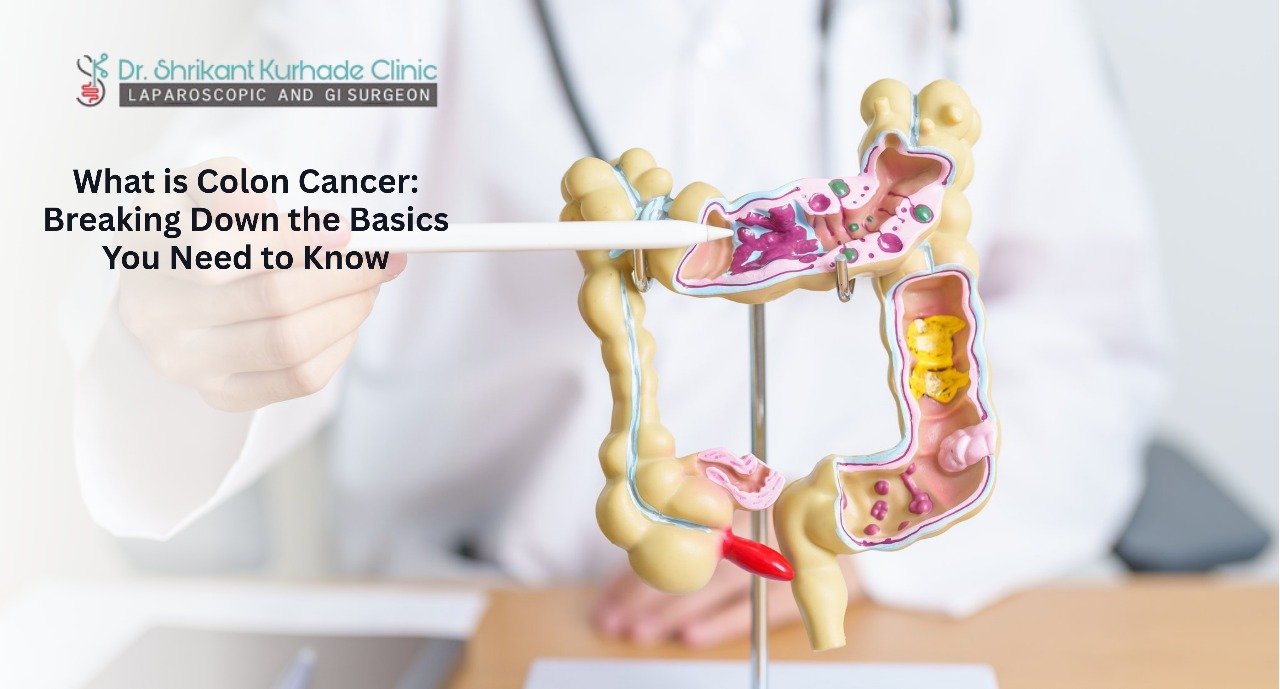 What is Colon Cancer? Key Facts You Need to Know